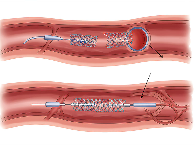What minimally invasive procedures are offered through interventional ...